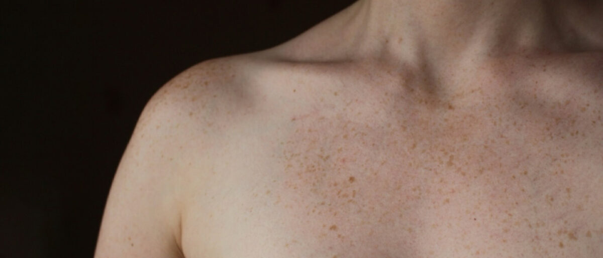 Age Spots, Brown Spots, Freckles - Dermatology, Laser & Vein ...