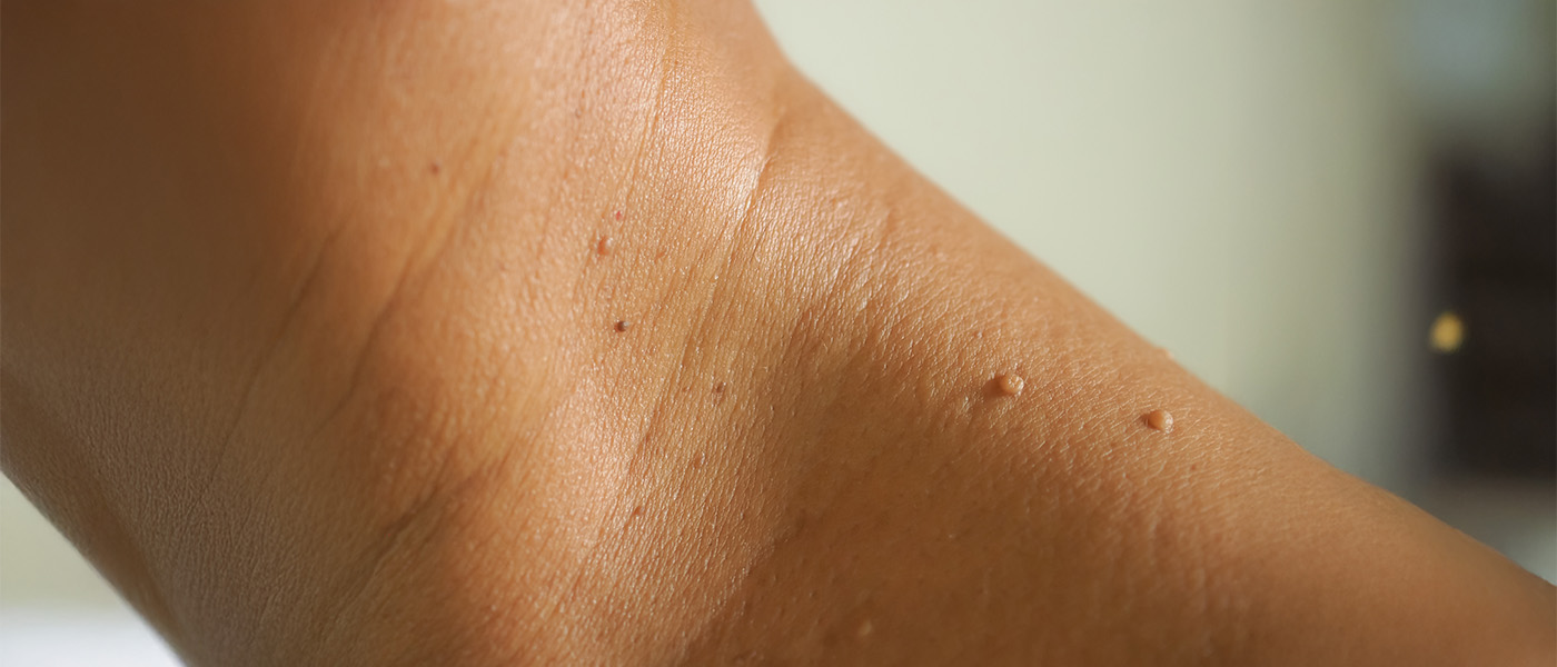 Birthmarks & Benign Skin Growths - Dermatology, Laser & Vein ...