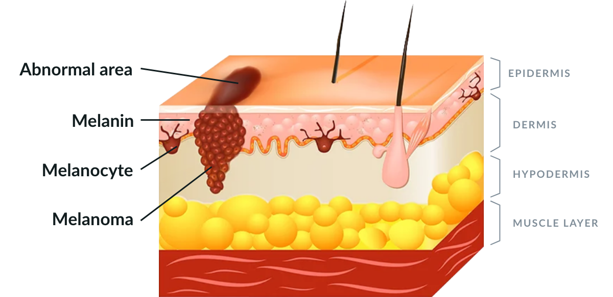 Skin Cancer - Dermatology, Laser & Vein Specialists of the Carolinas